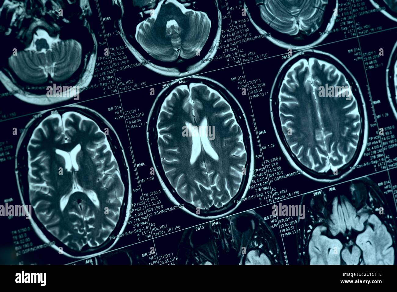 Mri image of the brain hi-res stock photography and images - Alamy