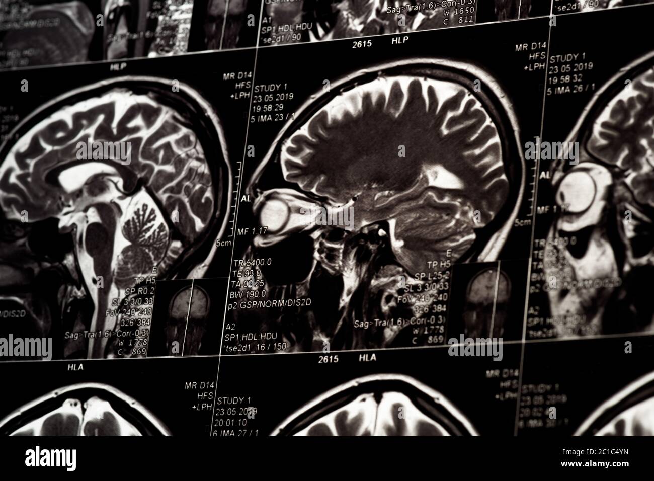 MRI scan of human brain, monochrome Stock Photo - Alamy