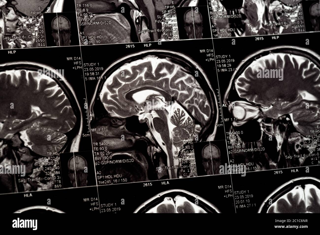 Brain MRI of an adult male, monochrome Stock Photo - Alamy