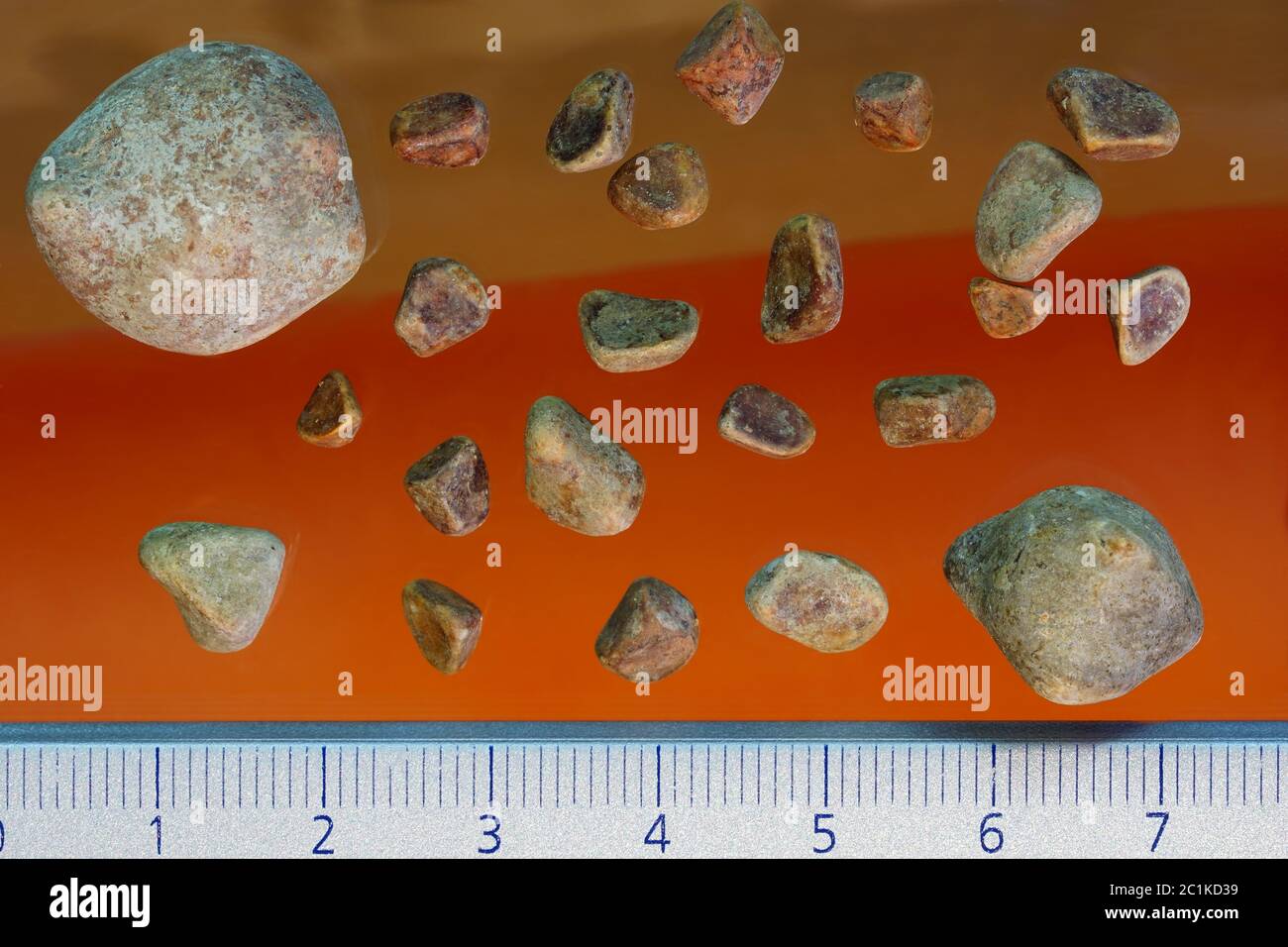 Gallstones hi-res stock photography and images - Alamy