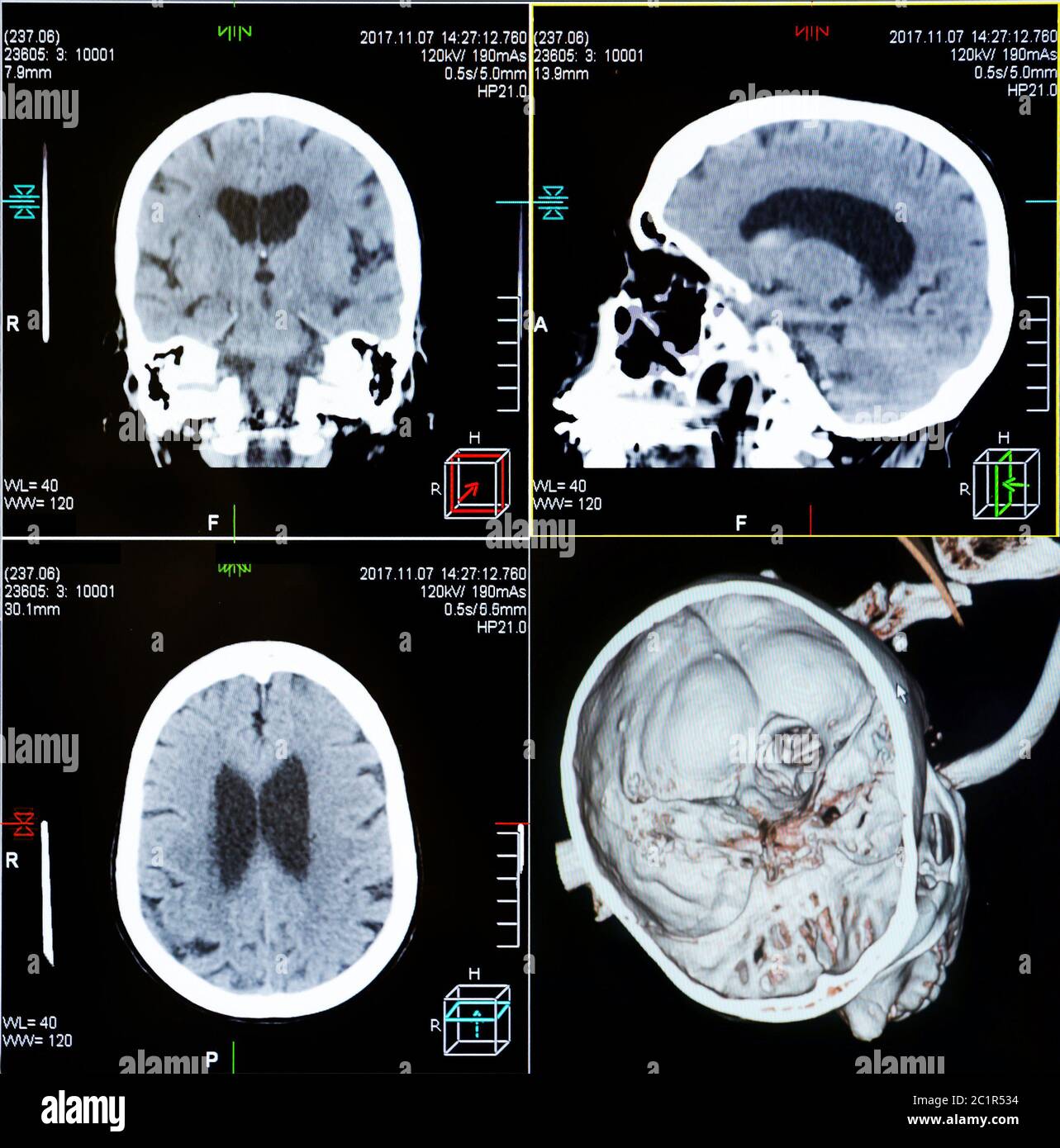CT scans of human head Stock Photo - Alamy