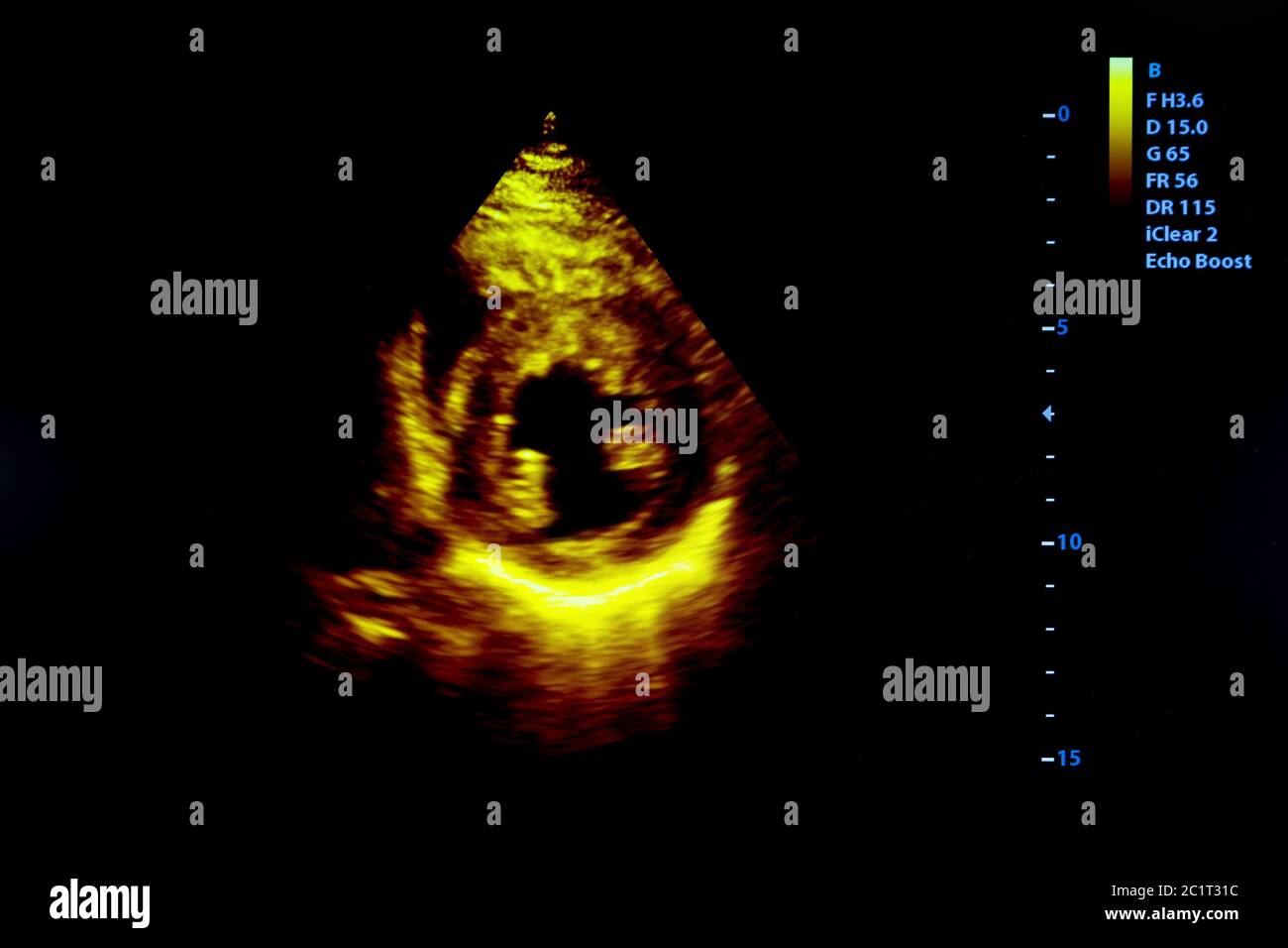 Cardiac ultrasound hi-res stock photography and images - Alamy