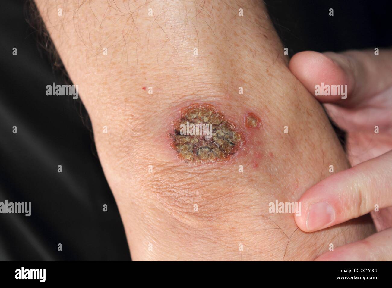 Ekzem hi-res stock photography and images - Alamy