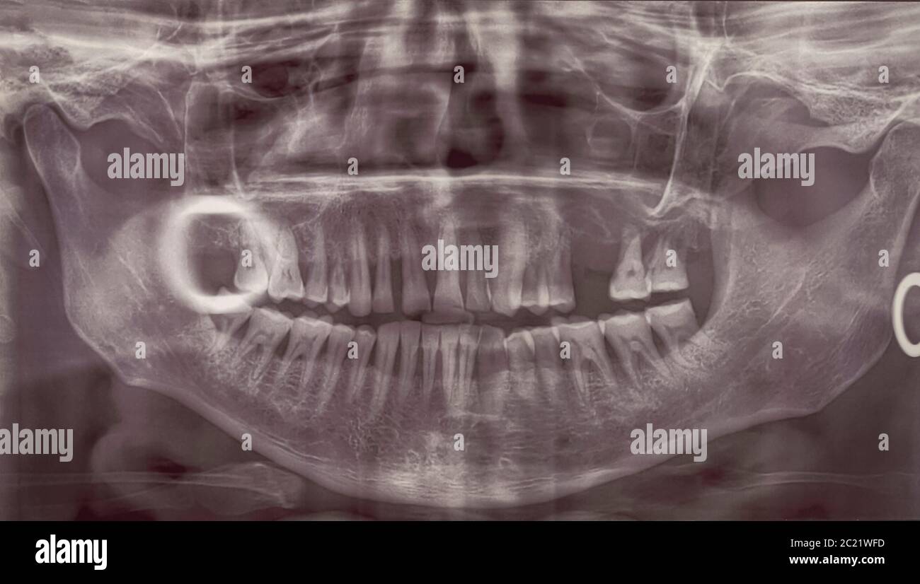 X Ray Of Bad Teeth