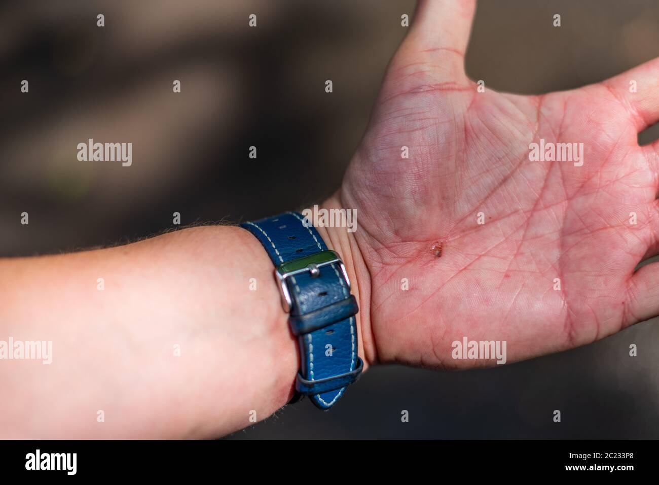 Open wound hi-res stock photography and images - Alamy