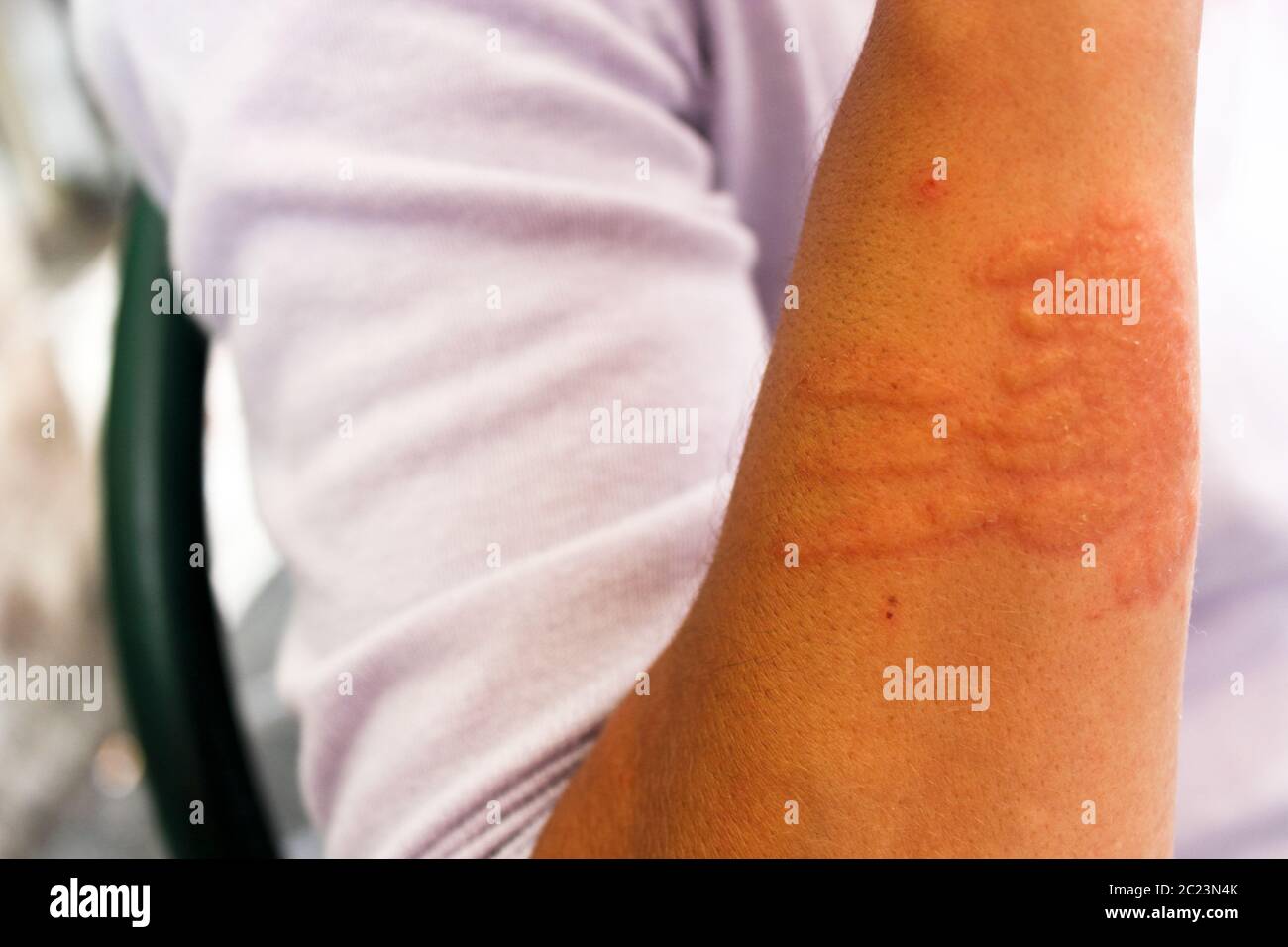 skin allergy skin allergy Stock Photo - Alamy