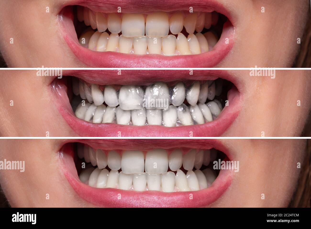 Close-up Detail Of Smiling Woman Teeth Before And After Cleaning With ...