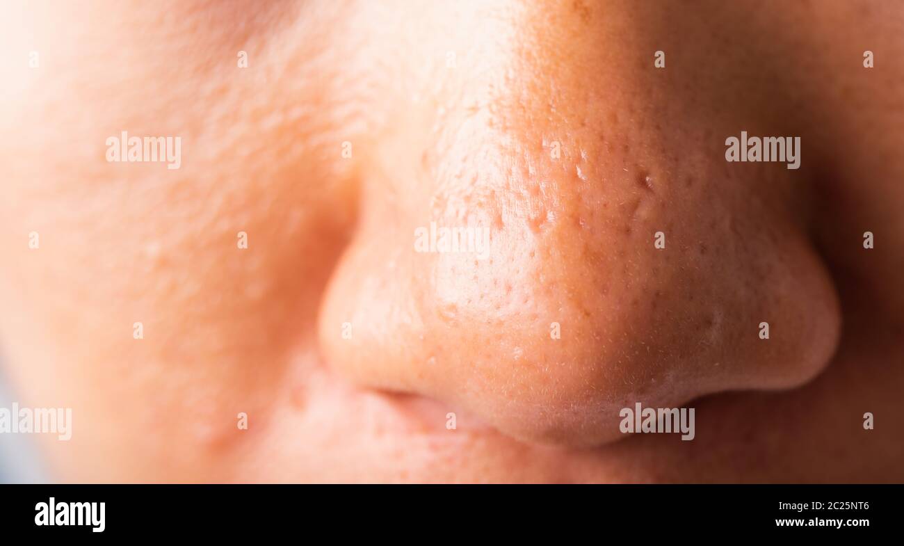 White pustules hi-res stock photography and images - Alamy