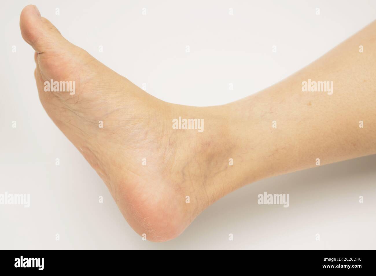 Cracked heels hi-res stock photography and images - Alamy