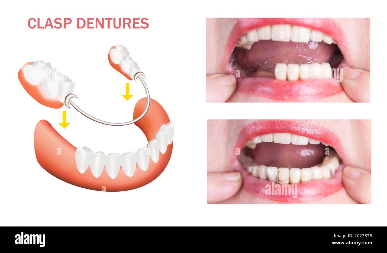 Dental bridge before after hi-res stock photography and images - Alamy