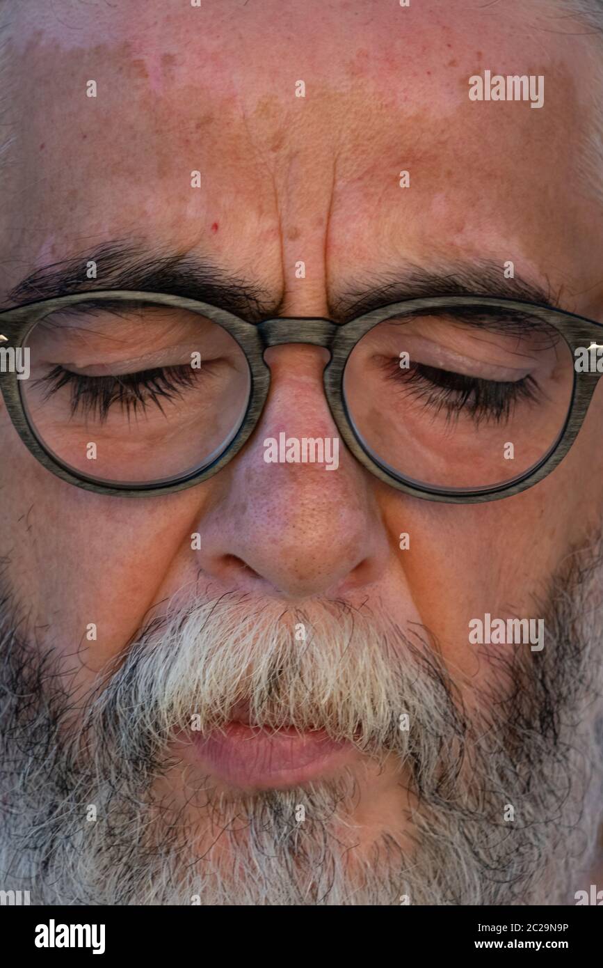 Vitiligo body hi-res stock photography and images - Alamy