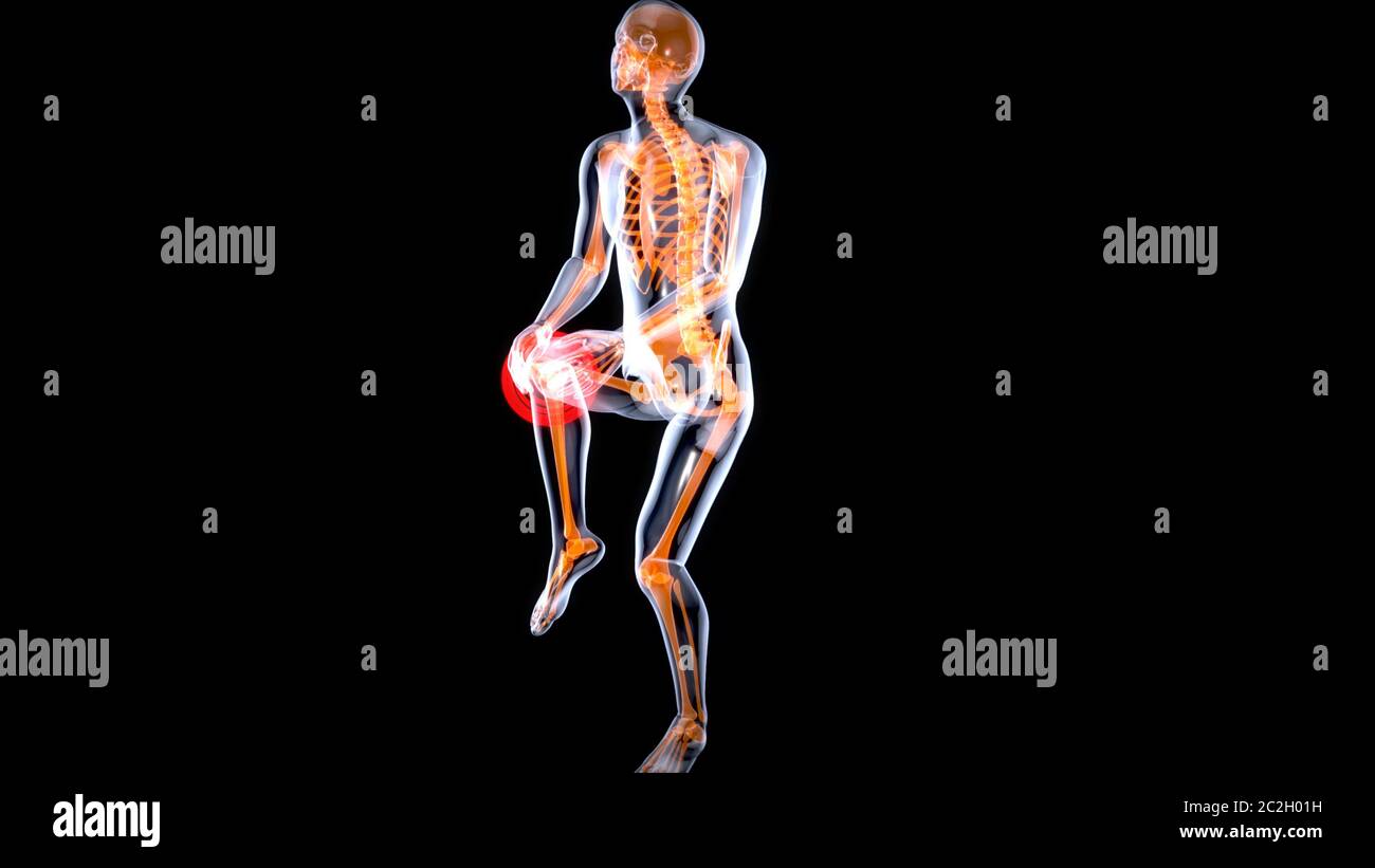 Knee sprain or ache leading to pain 3D illustration Stock Photo - Alamy