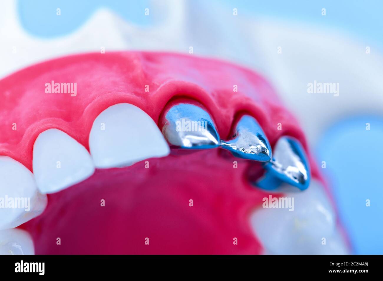 Tooth implant and crown installation process Stock Photo - Alamy