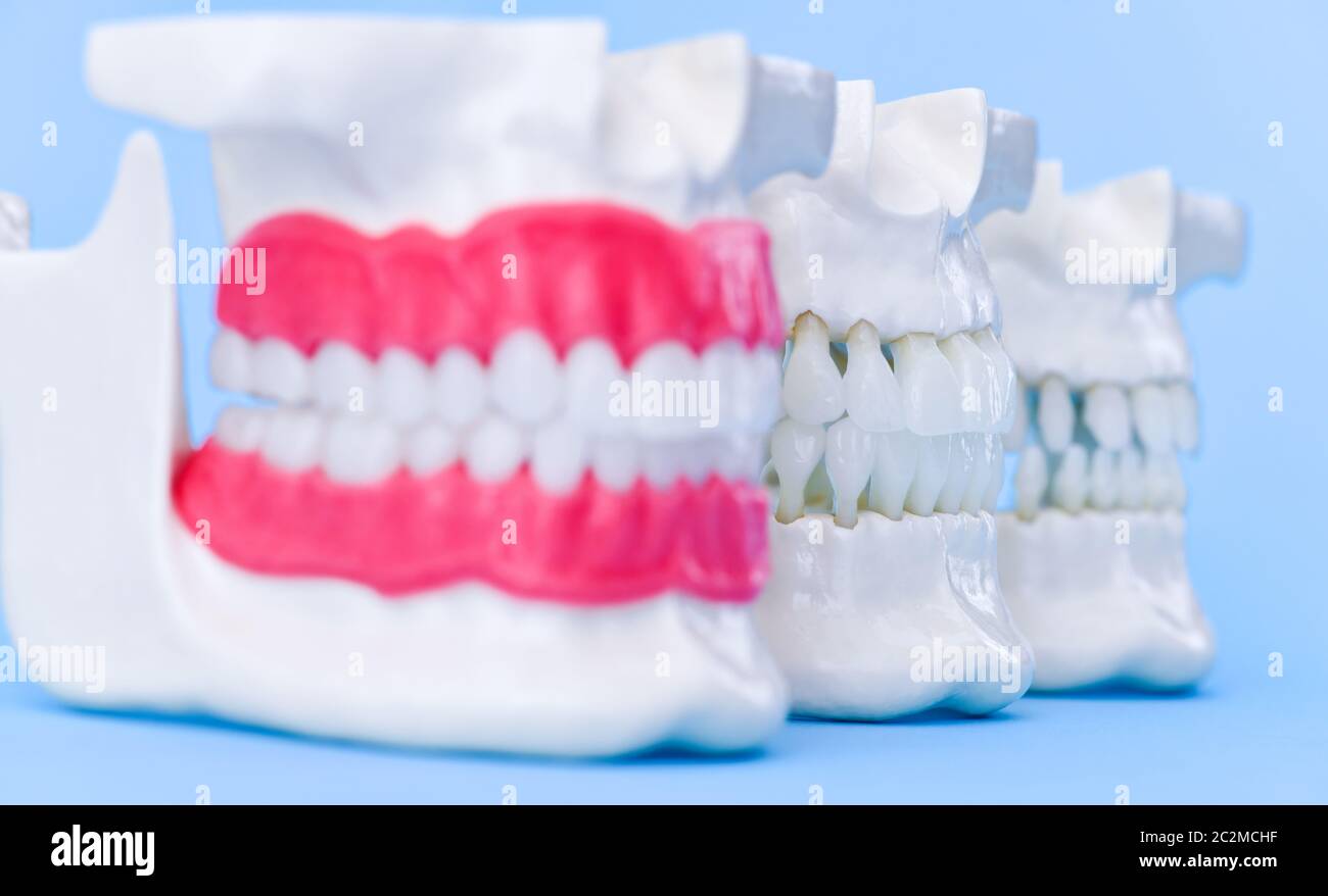 Human jaws with teeth and gums anatomy models Stock Photo - Alamy
