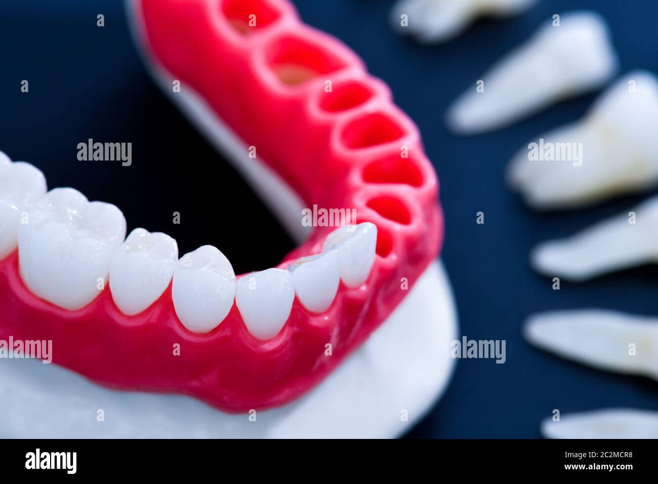 Tooth implant and crown installation process Stock Photo - Alamy