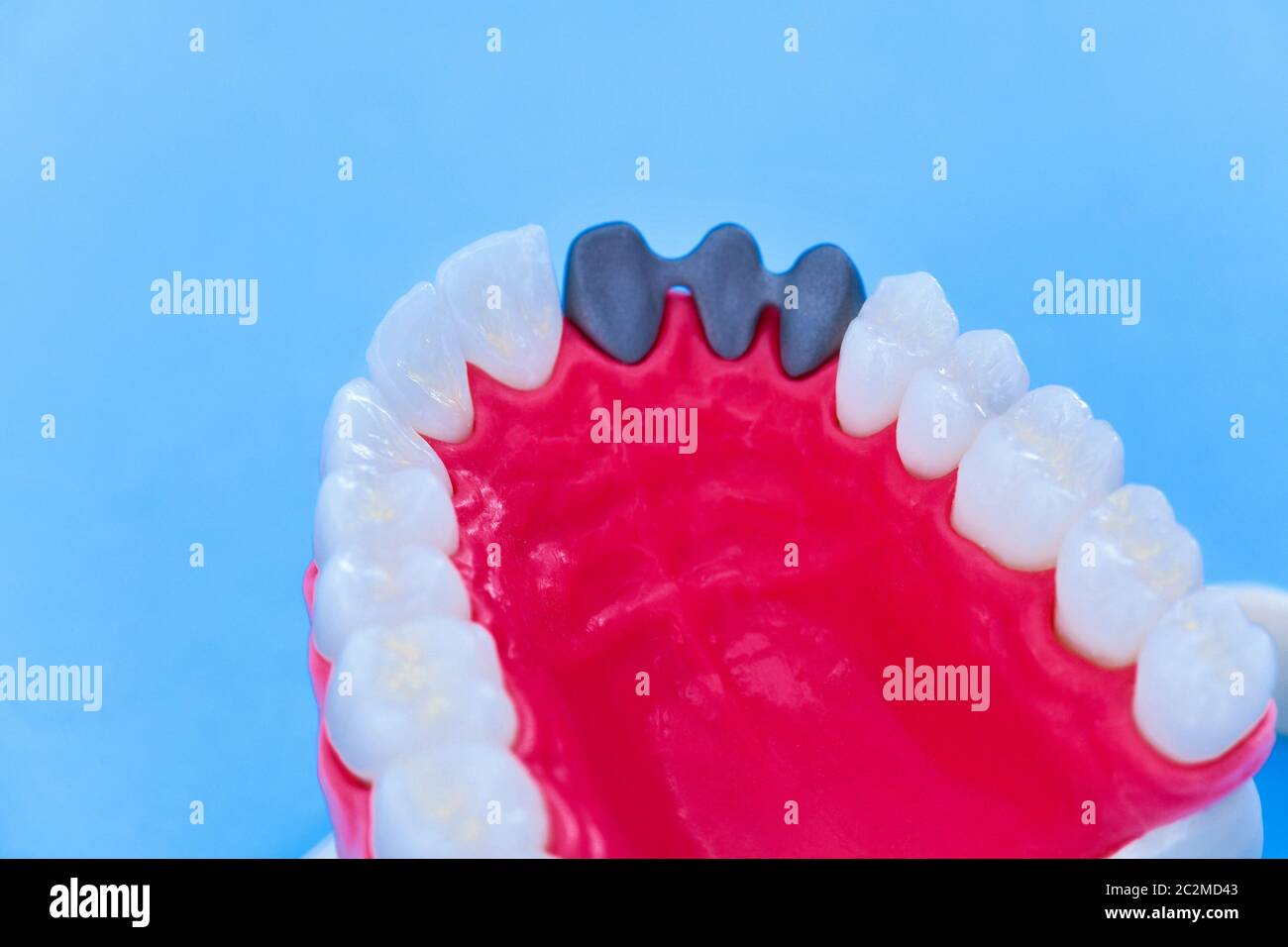 Tooth implant and crown installation process Stock Photo - Alamy