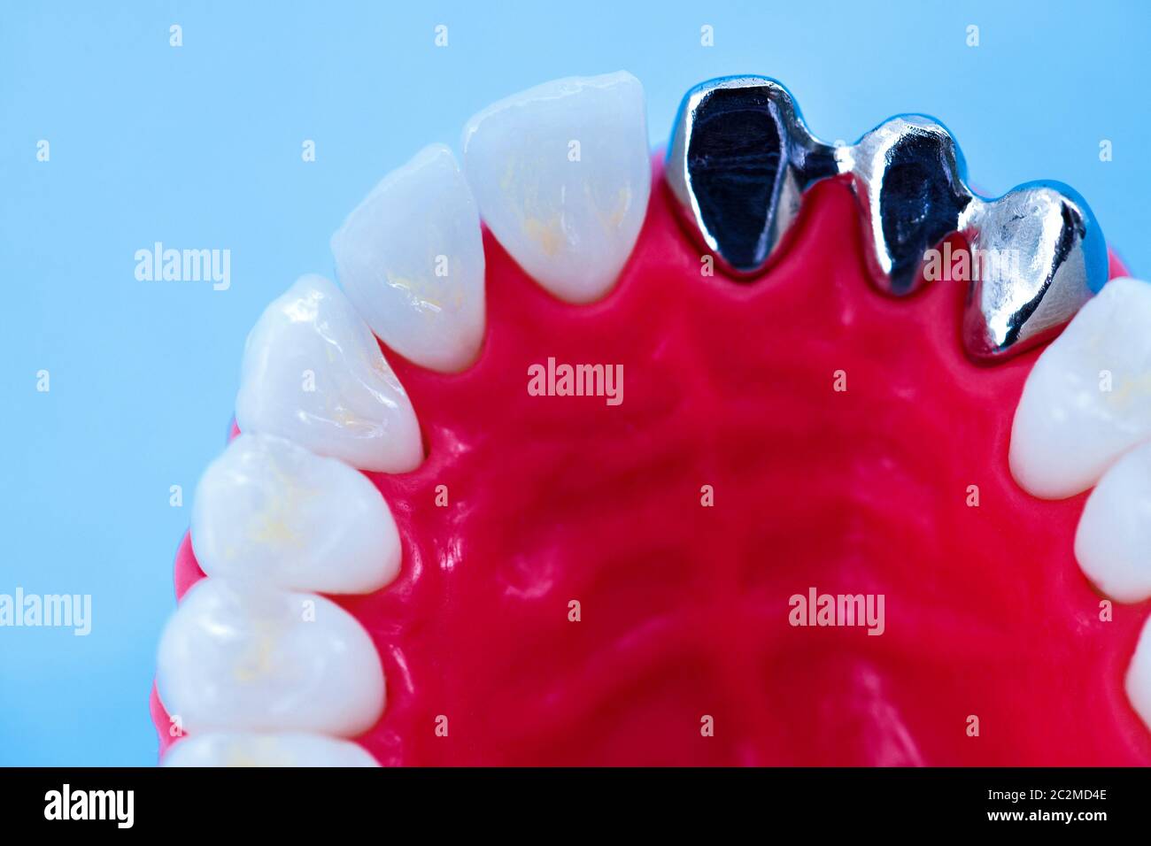 Tooth implant and crown installation process Stock Photo - Alamy