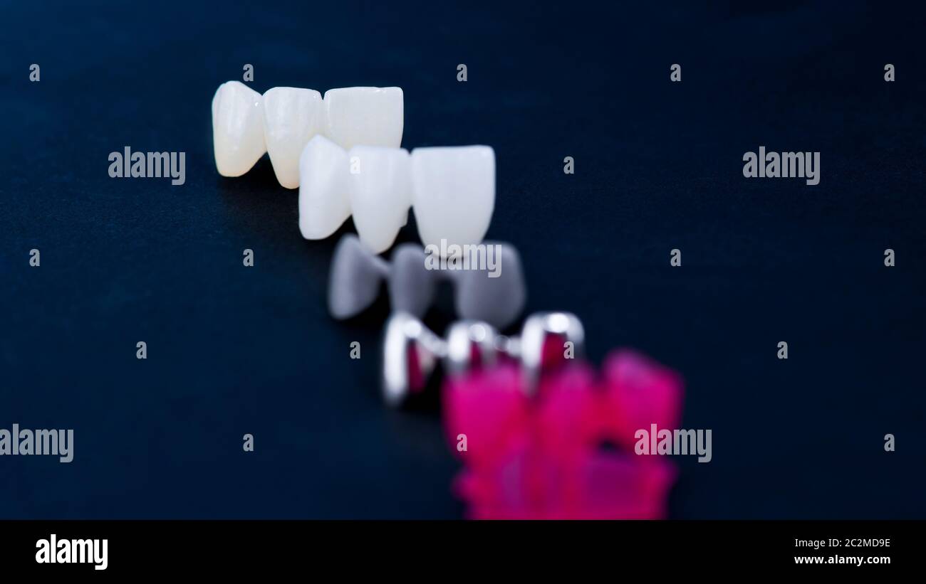 different types of dental tooth crowns Stock Photo - Alamy