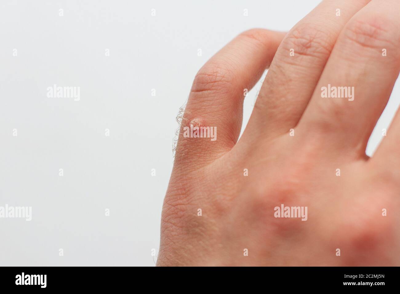 wart on hand, skin problem Stock Photo - Alamy