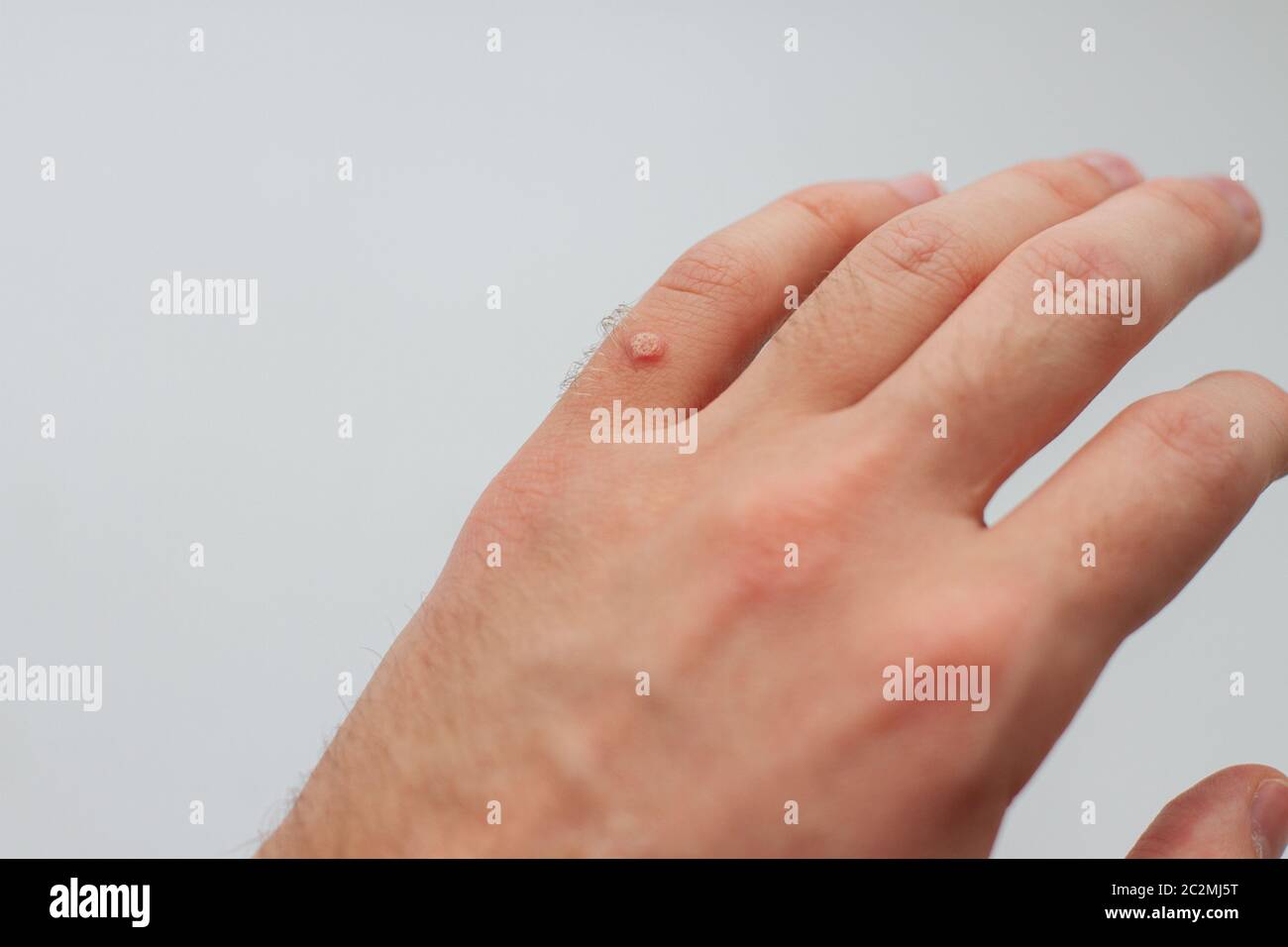 Wart finger hi-res stock photography and images - Alamy