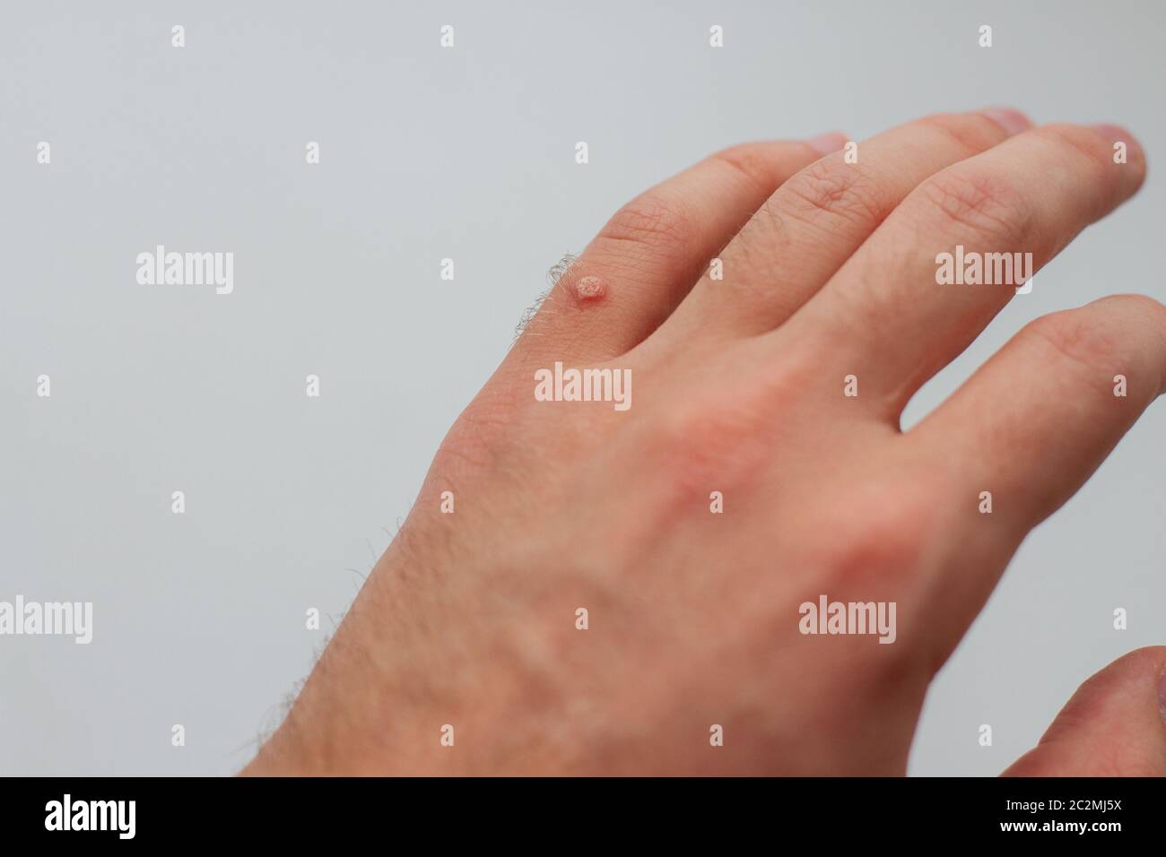 wart on hand finger isolated on white background Stock Photo - Alamy