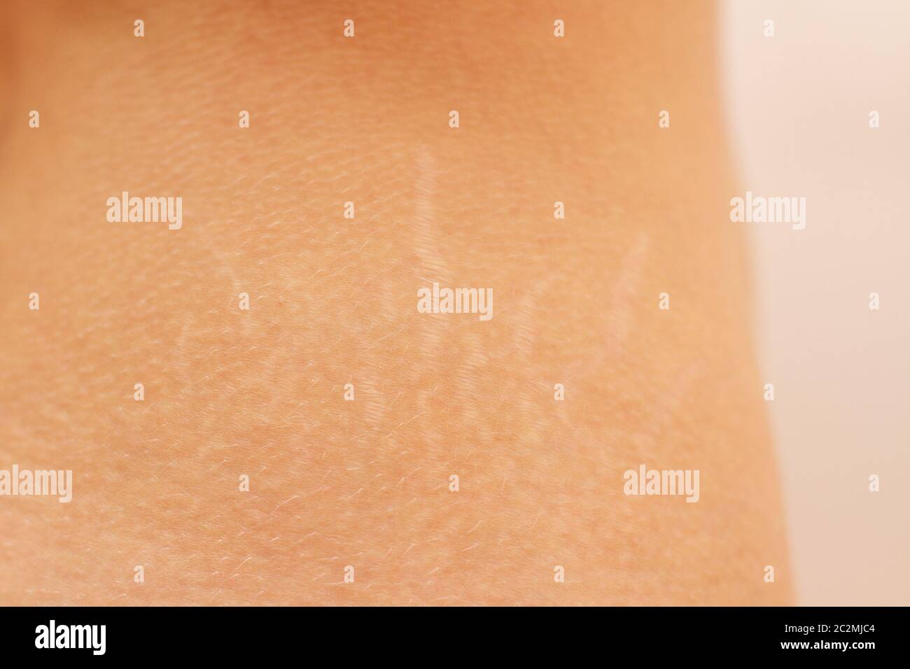 Stretch marks on the skin hi-res stock photography and images - Alamy