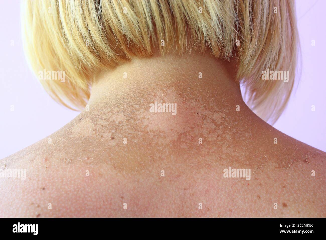 Human neck burnt after sunburn. Scald of neck made by sunny beams ...