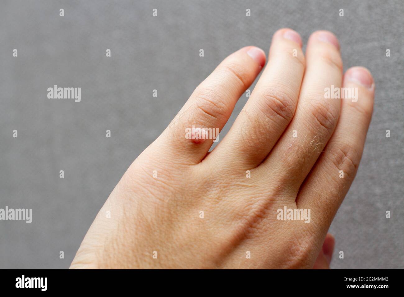 Wart finger hi-res stock photography and images - Alamy