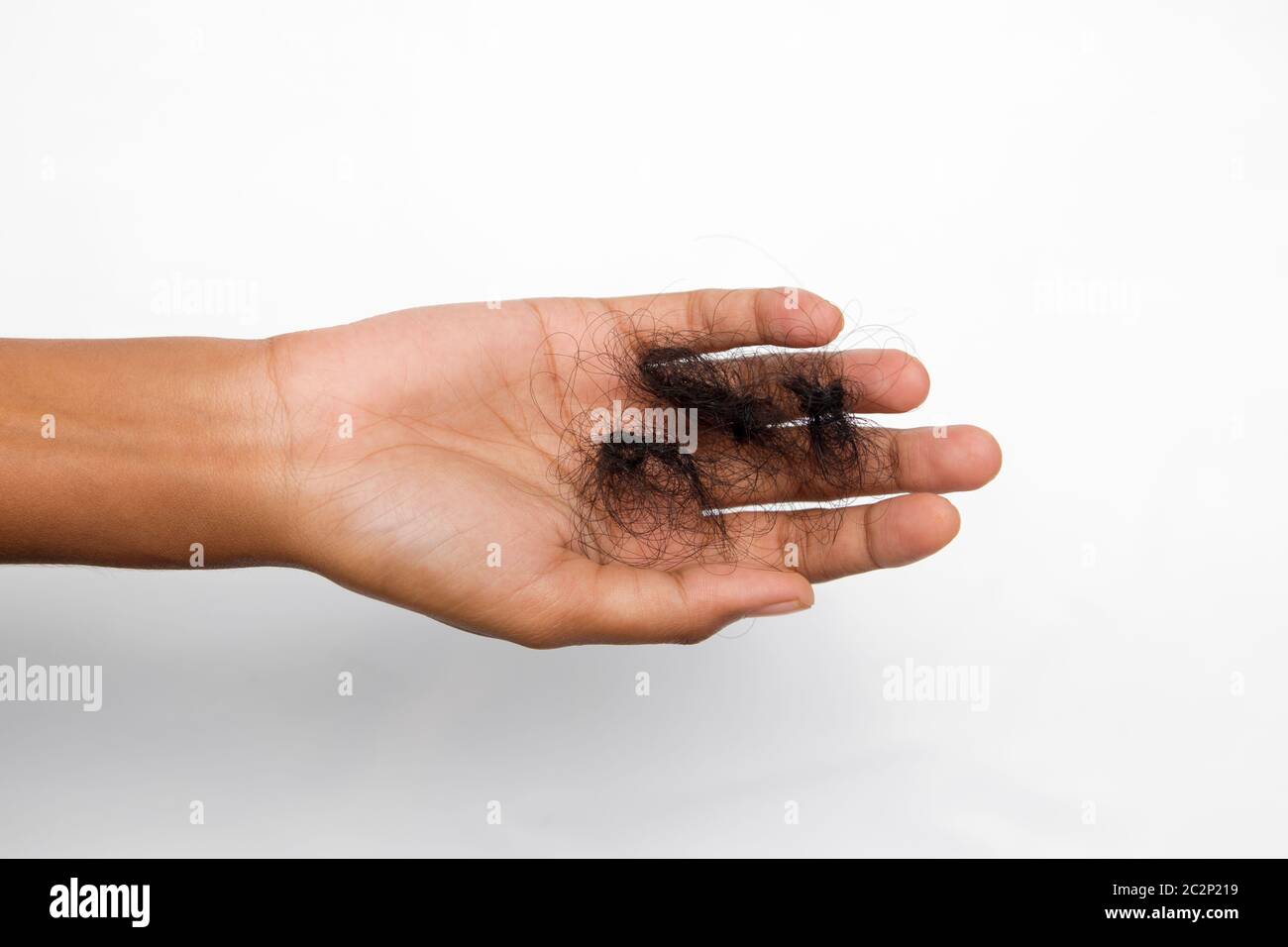 Pressure alopecia hi-res stock photography and images - Alamy