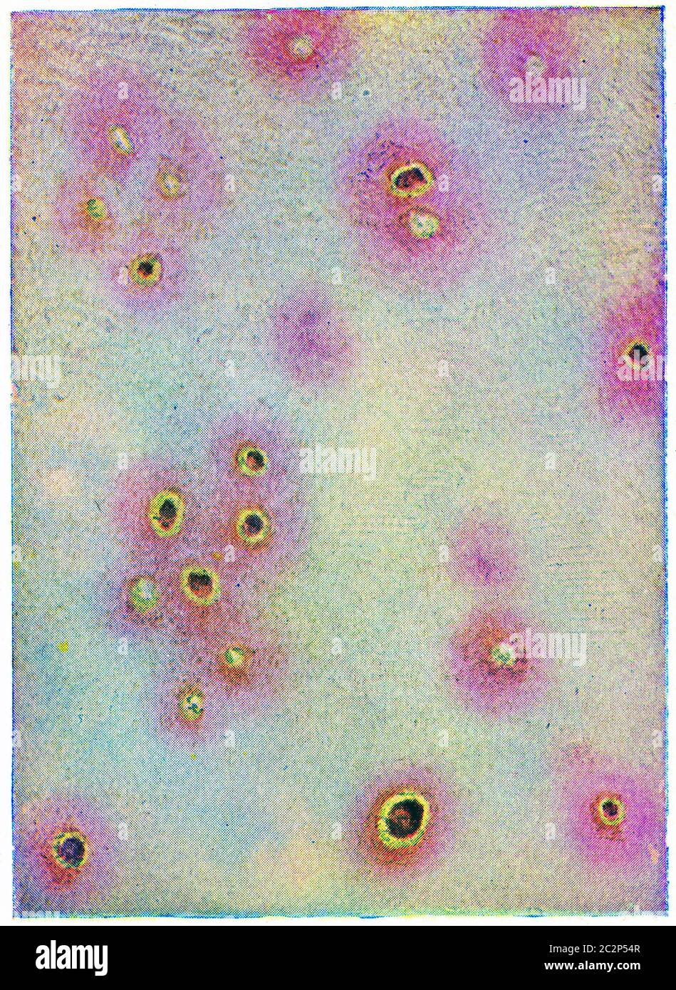 Chicken pox, vintage engraved illustration Stock Photo - Alamy