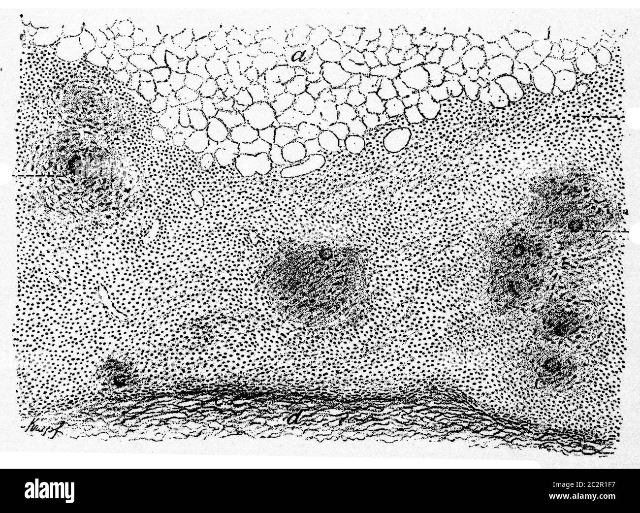 Granulation Tissue Arm