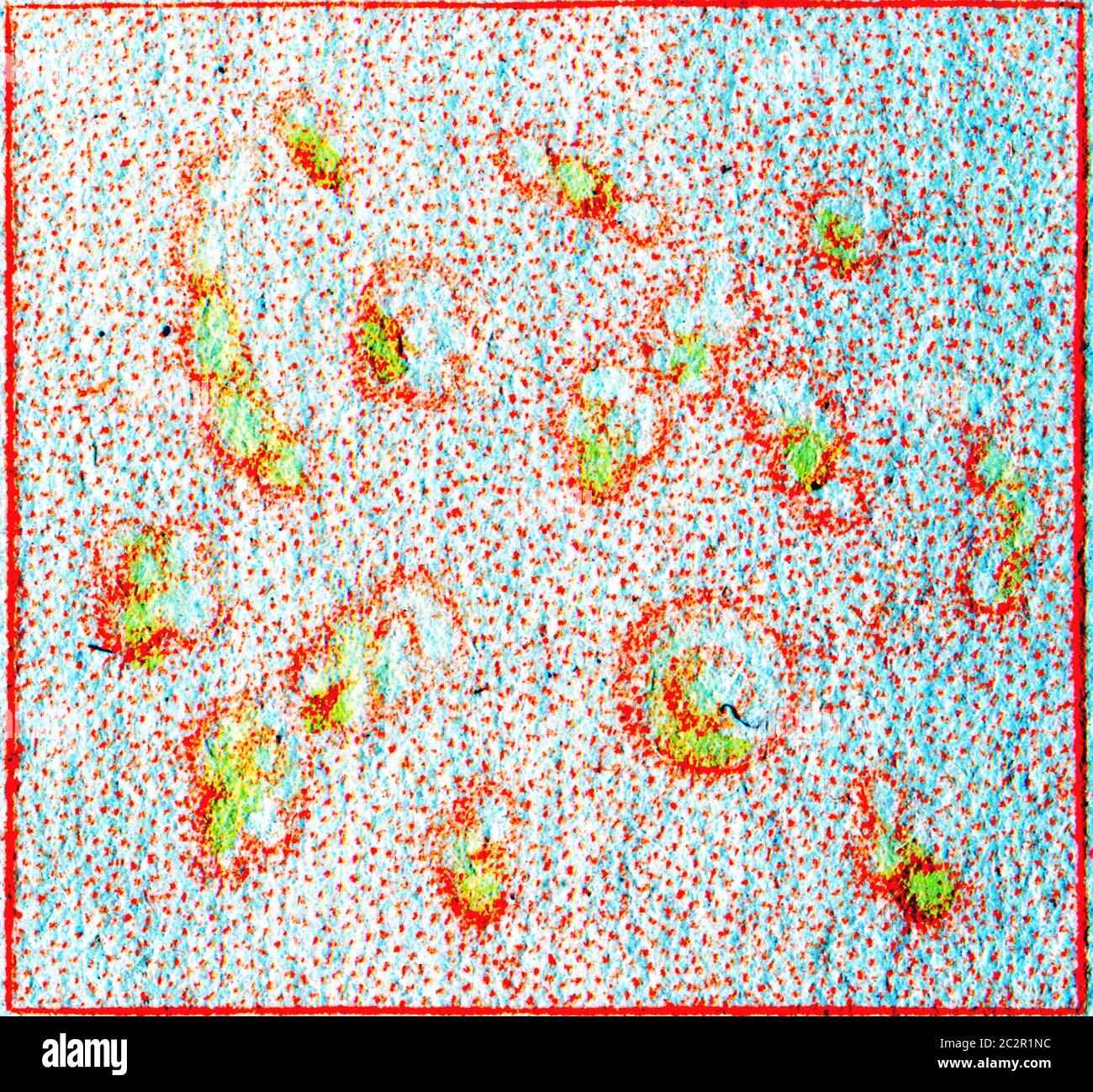 Smallpox discrete, vintage engraved illustration Stock Photo - Alamy