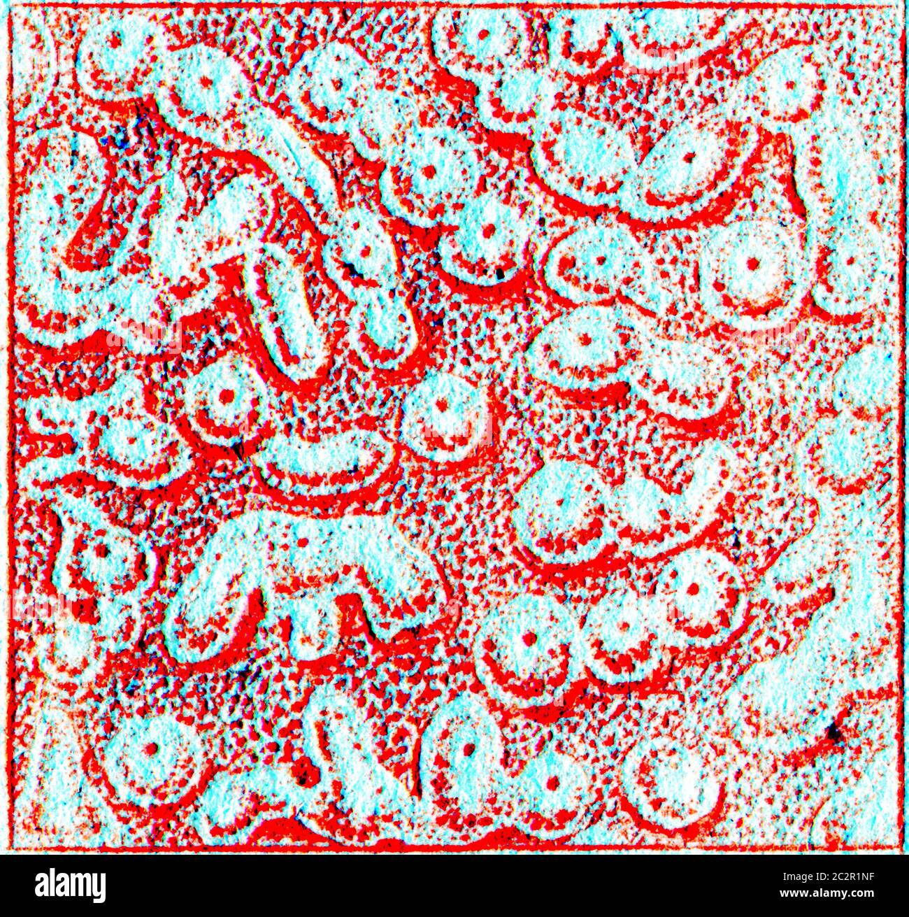 Confluent smallpox, vintage engraved illustration Stock Photo - Alamy