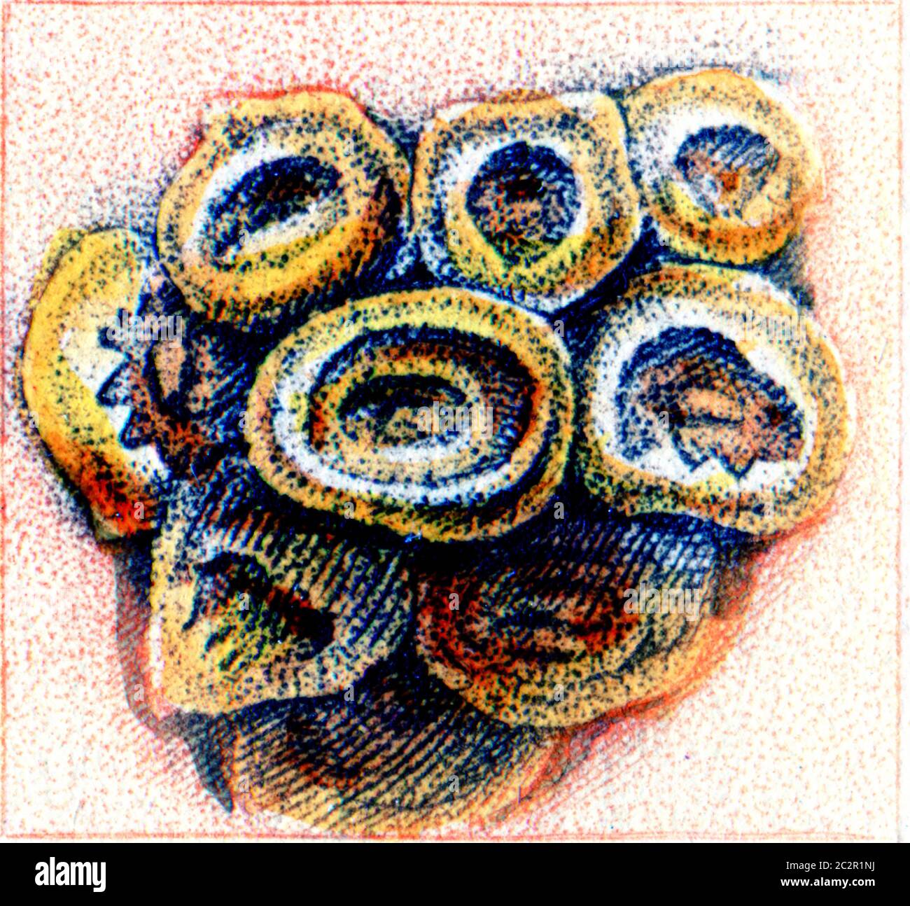 Impetigo and ringworm, vintage engraved illustration Stock Photo - Alamy