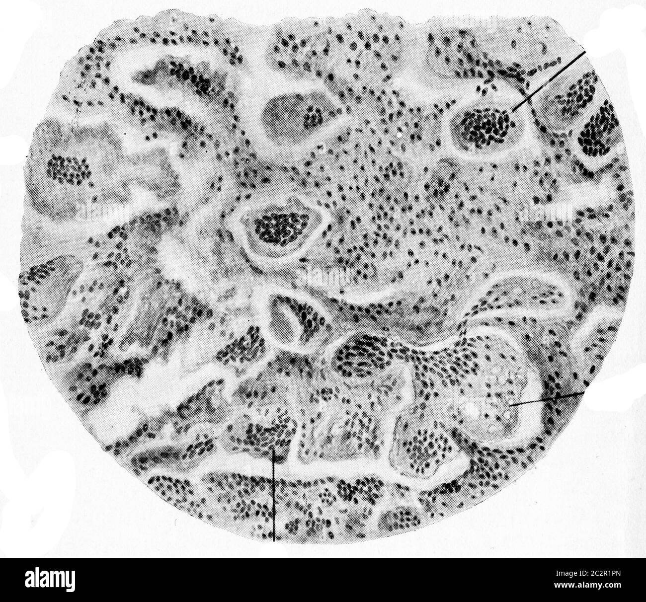 Giant cell sarcoma, vintage engraved illustration Stock Photo - Alamy