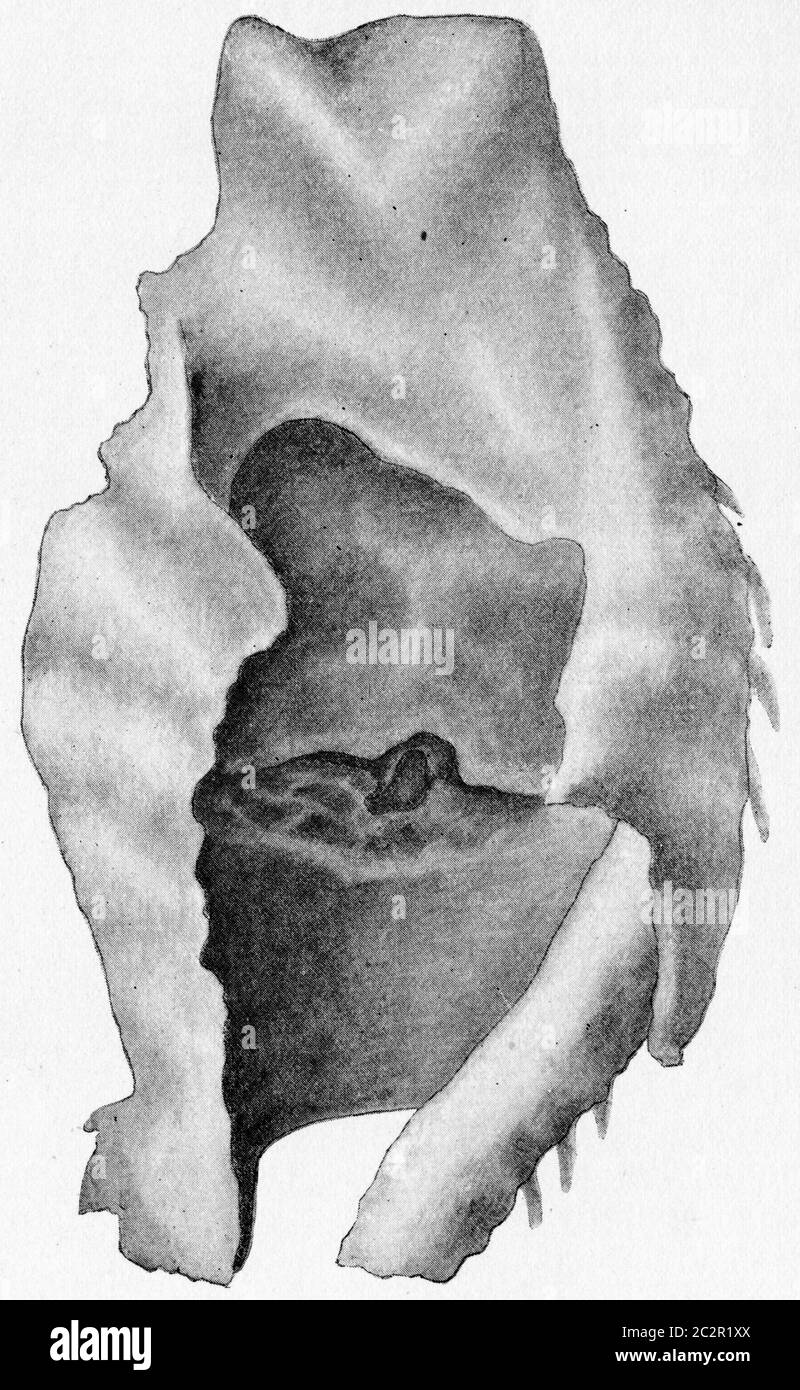 Perichondritis hi-res stock photography and images - Alamy
