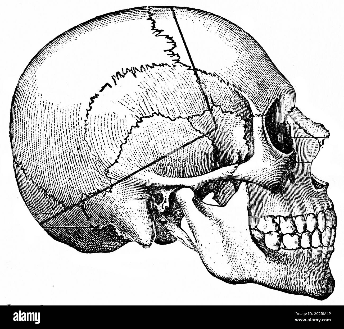 Heavy line indicating course taken by saw-cut in so called undertaker's ...