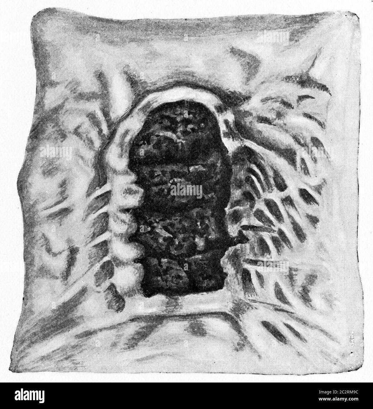 Small intestine, typhoid ulcer during the early part of third week of ...