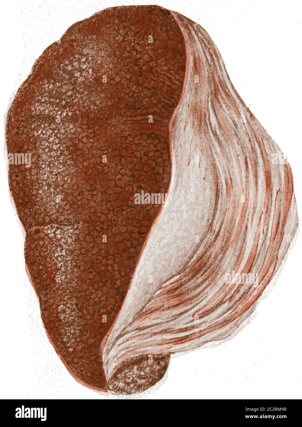 Chronic kidney disease human Cut Out Stock Images & Pictures - Alamy