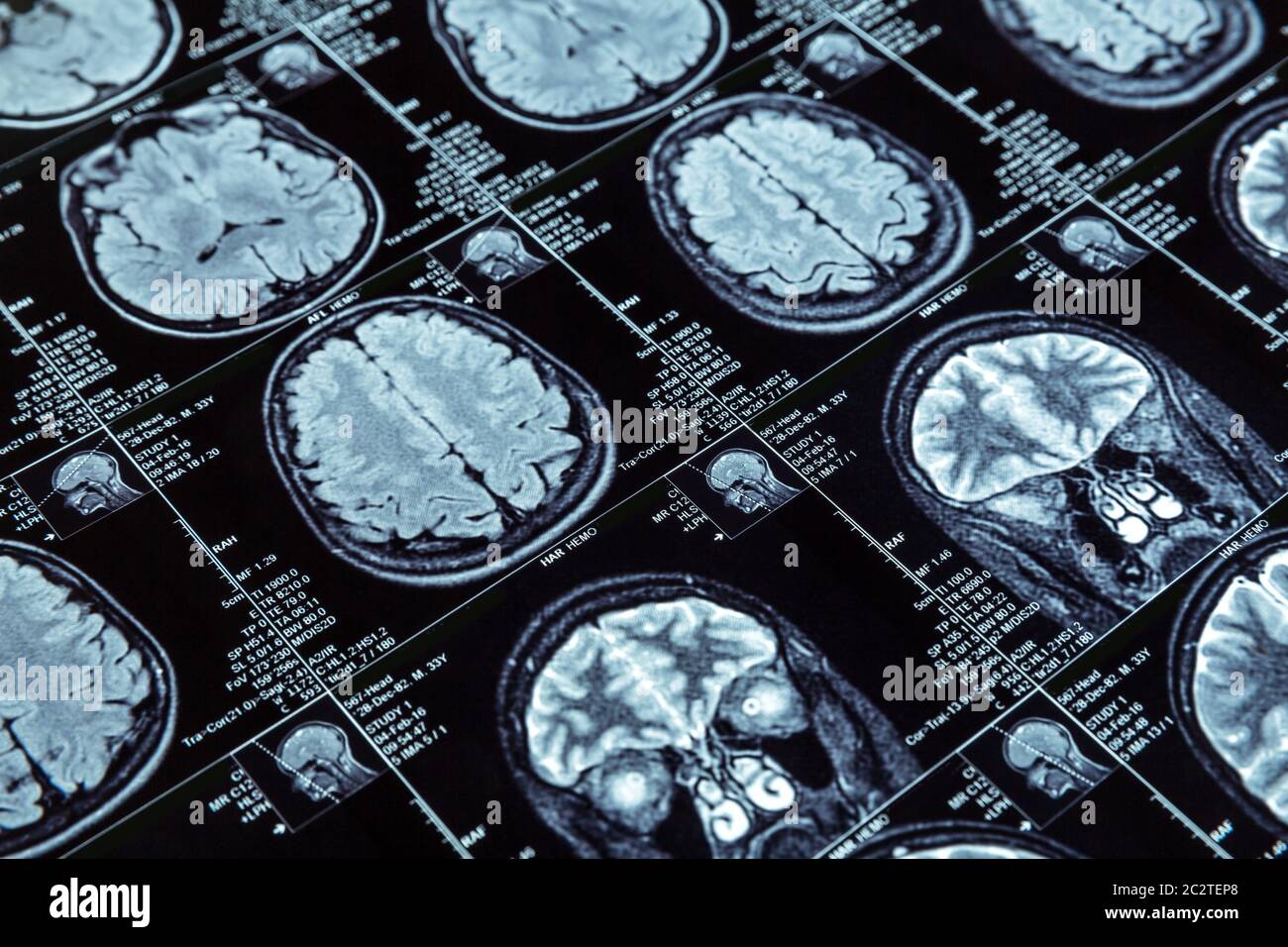 Closeup of magnetic resonance imaging photography of human brain Stock ...