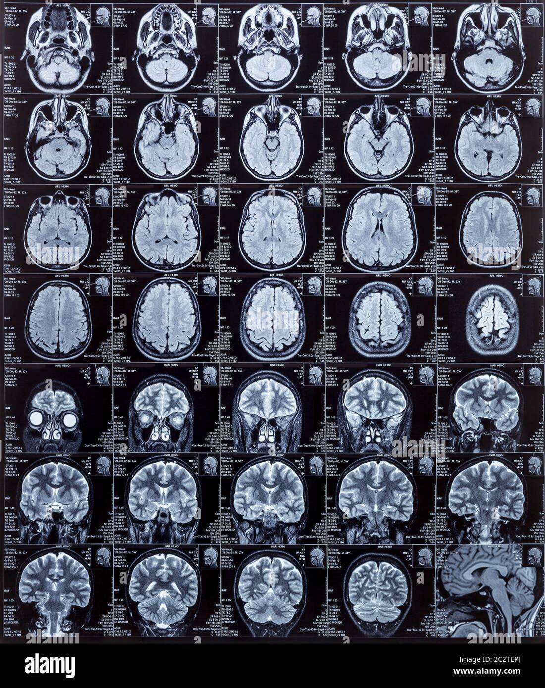 Magnetic resonance imaging photography of human brain Stock Photo - Alamy