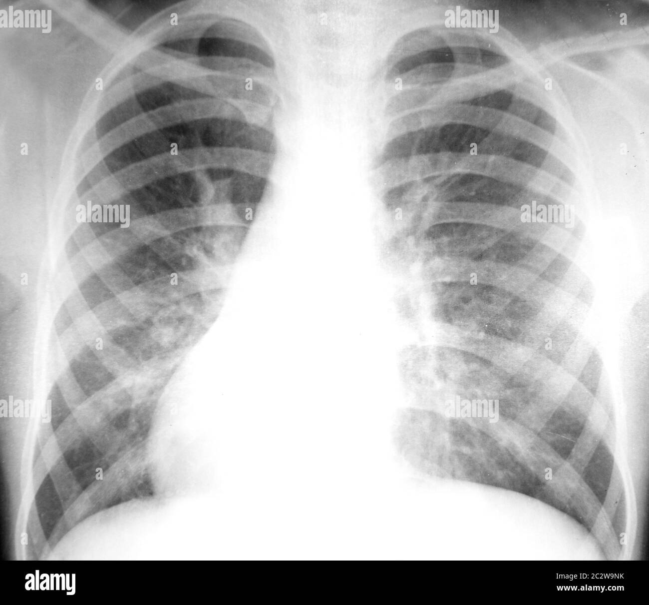 Chest X-ray image Stock Photo - Alamy