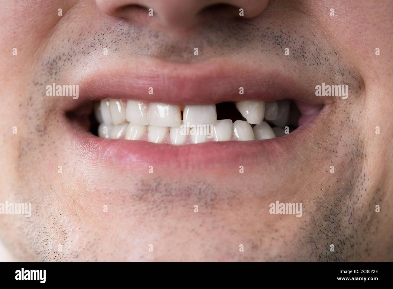 Missing Teeth Man High Resolution Stock Photography and Images - Alamy