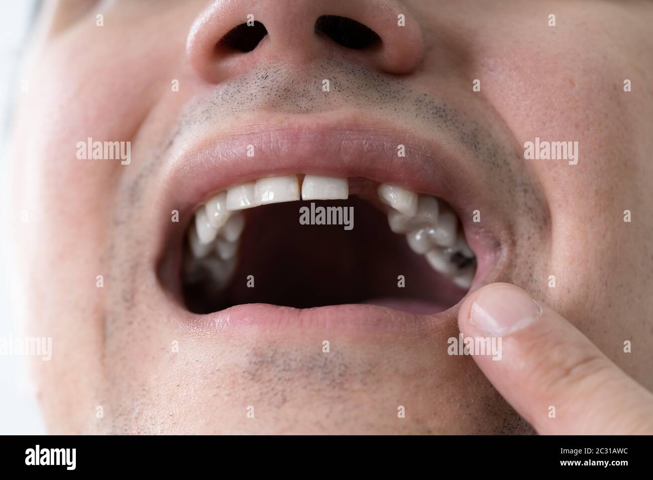 Close Up Photo Of Young Man With Missing Tooth Stock Photo - Alamy