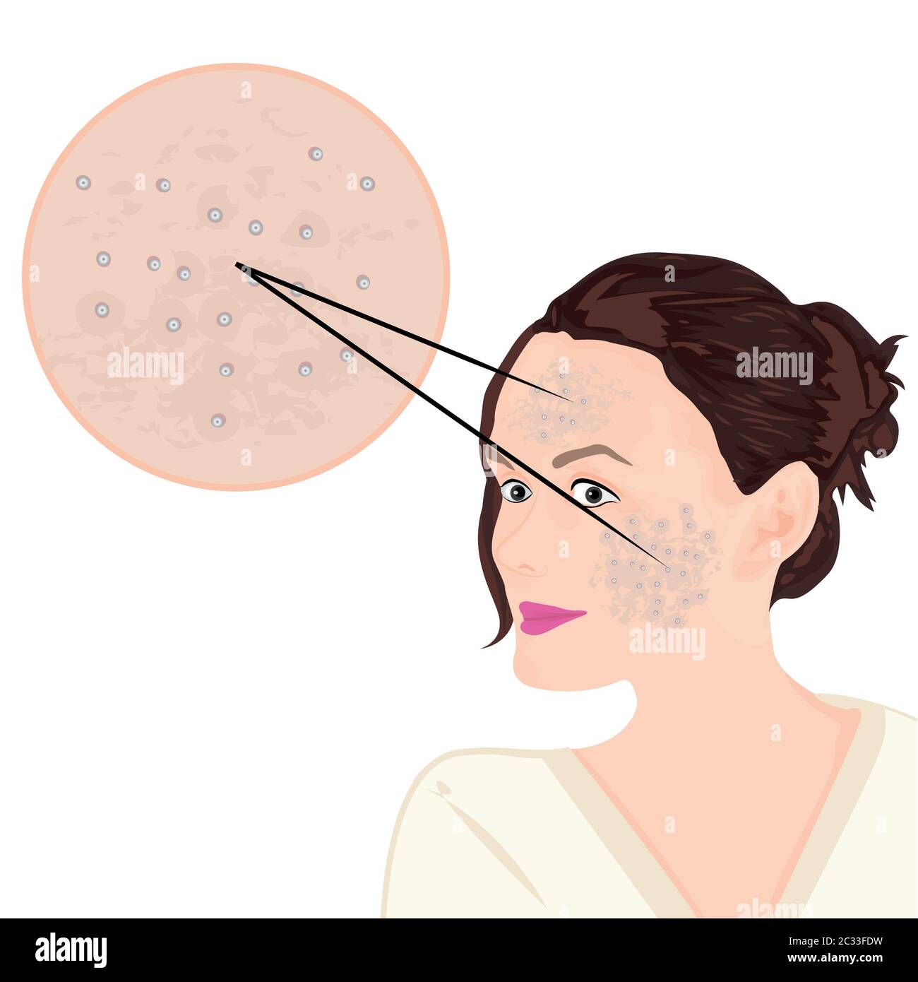 Acne on a face vector illustration showing skin problem Stock Photo - Alamy