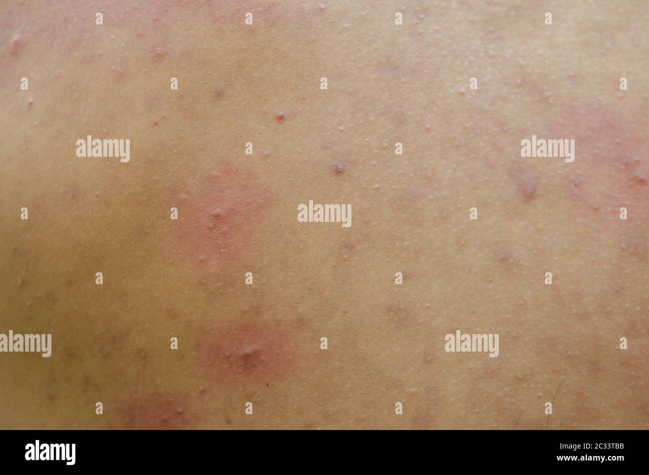 Asian teen boy Inflammatory acne on the back Stock Photo - Alamy