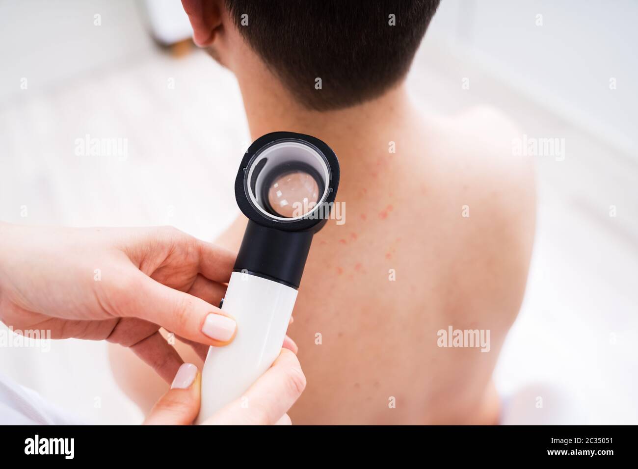Close-up Of Person Hands Examining Acne Skin Of Man With Dermatoscope ...