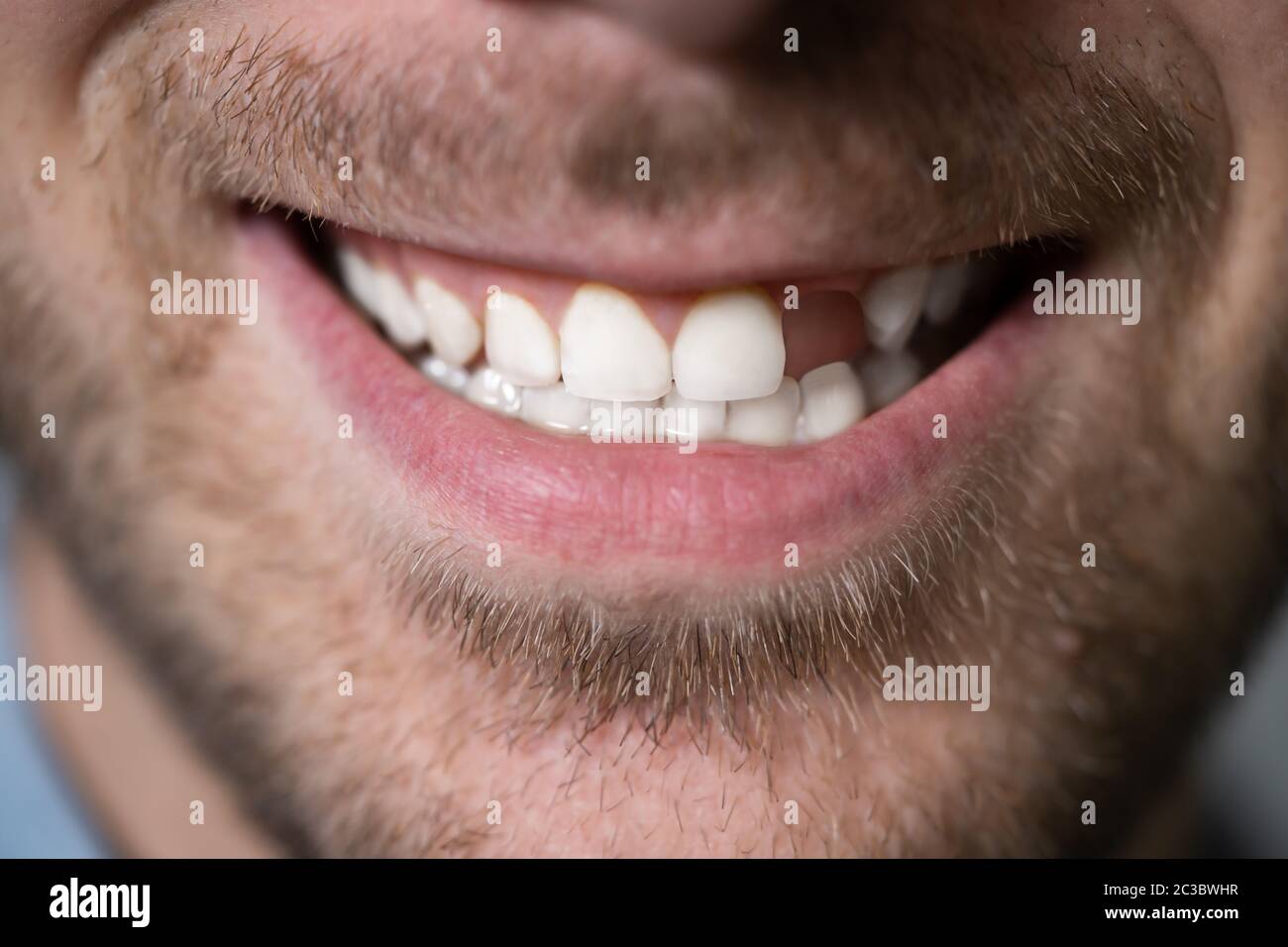 Man tooth gap hi-res stock photography and images - Alamy