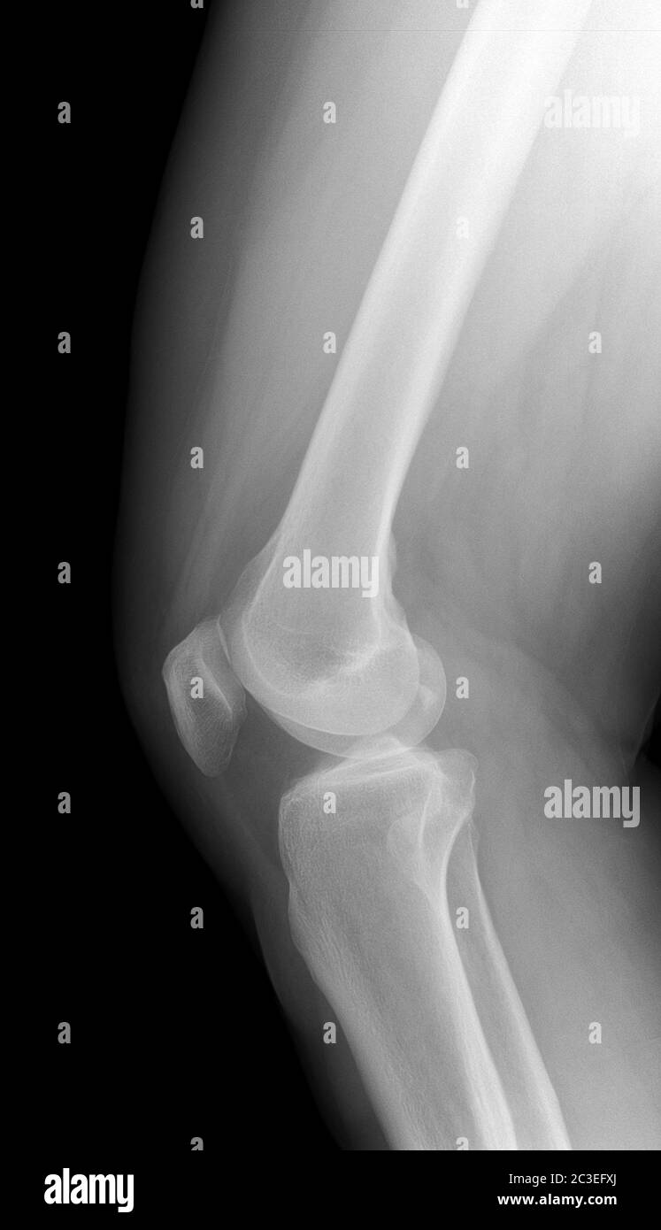 Image Of Knee X-Ray. Detecting Radiographic Knee Osteoarthritis Stock ...