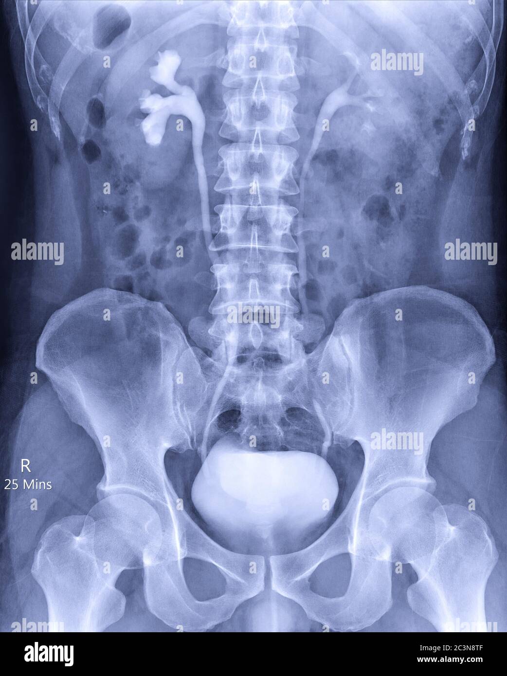 Intravenous pyelogram or I.V.P is an X-ray exam of urinary tract after ...